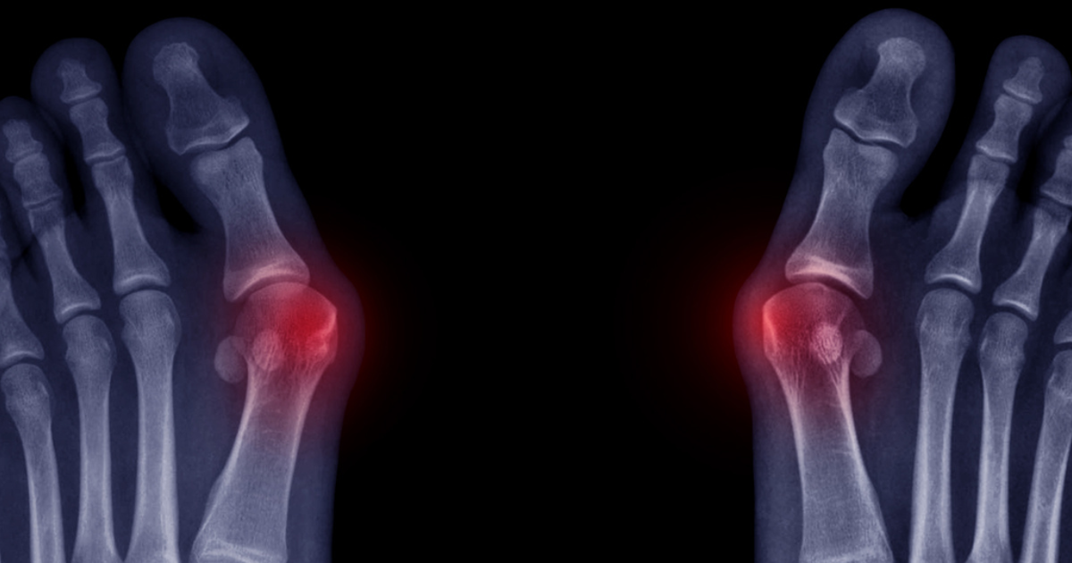 Lapiplasty 3D Bunion Correction Surgery - Wood County Hospital